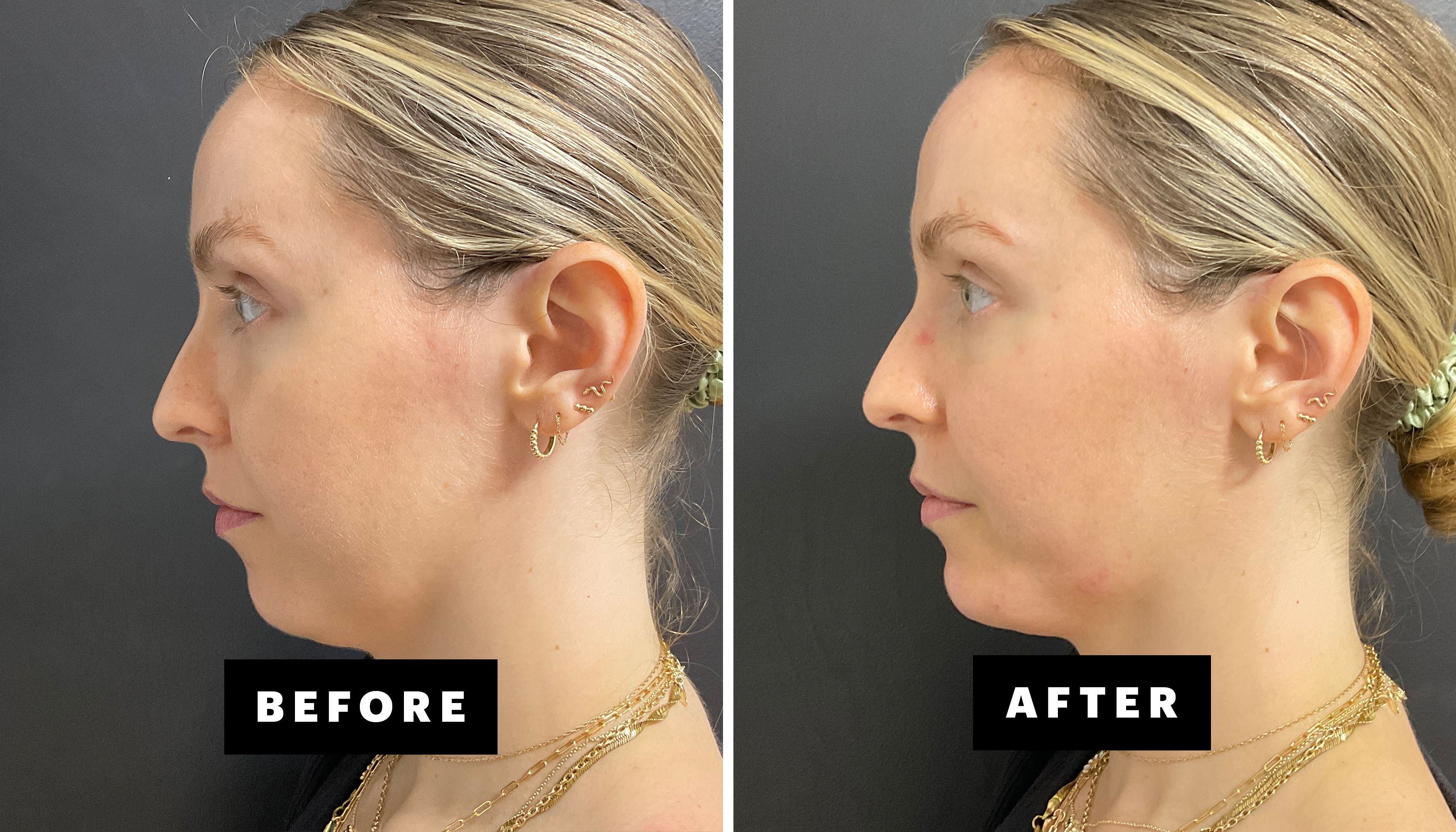 I got chin filler for my 'weak' chin