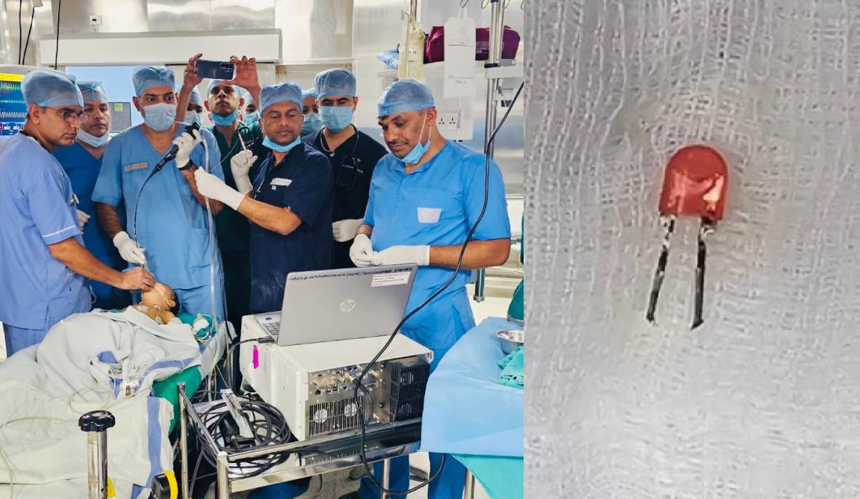 Indian Army doctors Remove LED bulb from 9-month-old infant's lung in ...