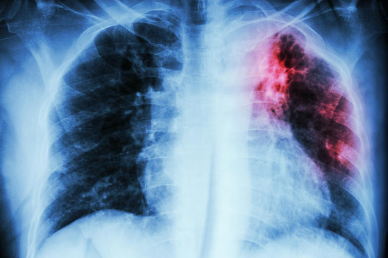 Montreal public health sets up squad to curb spike in tuberculosis cases