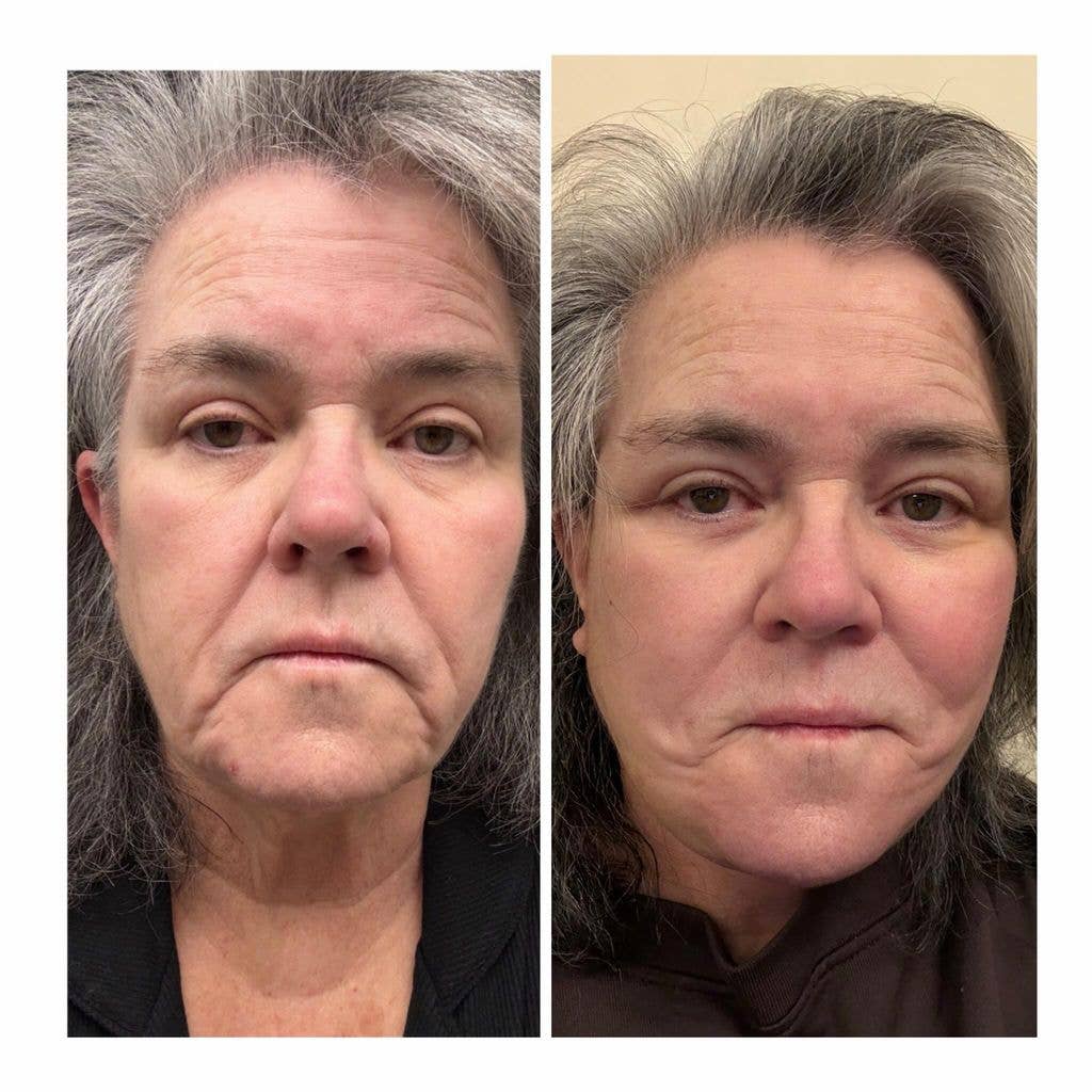 Celebrities who've had facelifts: see their dramatic results in before ...