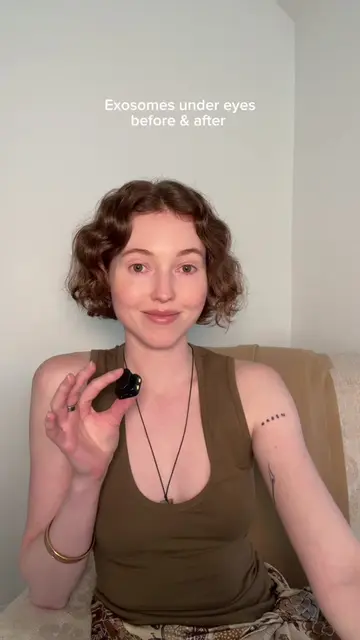 Under-eye exosomes six-week before and after results