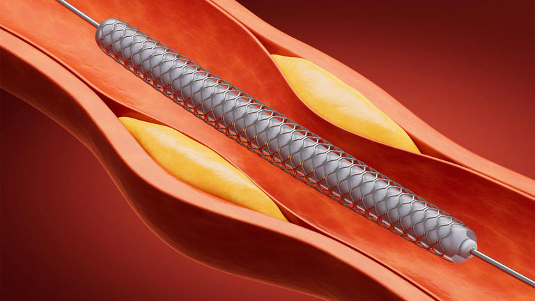 Over $100M billed for medically questionable vascular procedures, OIG finds