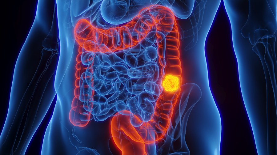 What's going around | New guidelines for colon cancer screening