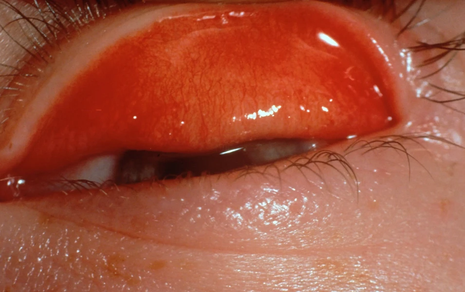 Pink eye decoded for everyday life