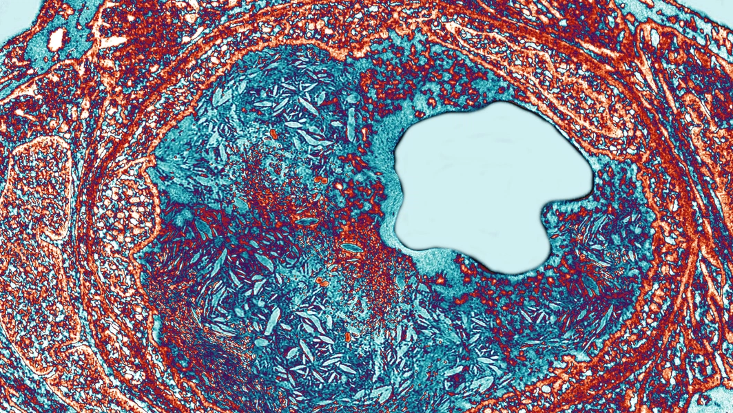 Manganese shows promise in reversing artery plaques in mice