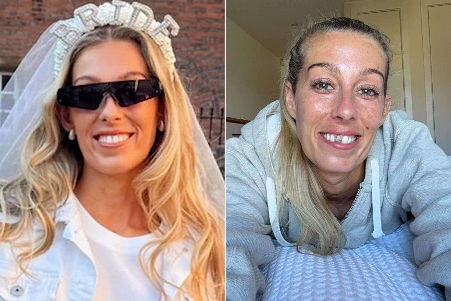 Bride’s front tooth fell out after she bit into pizza just days before ...
