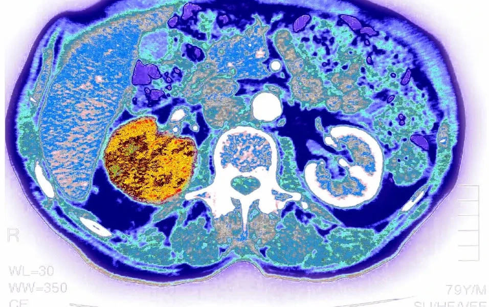 Navigating the future of kidney cancer care