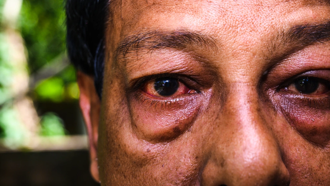 Pink eye decoded for everyday life