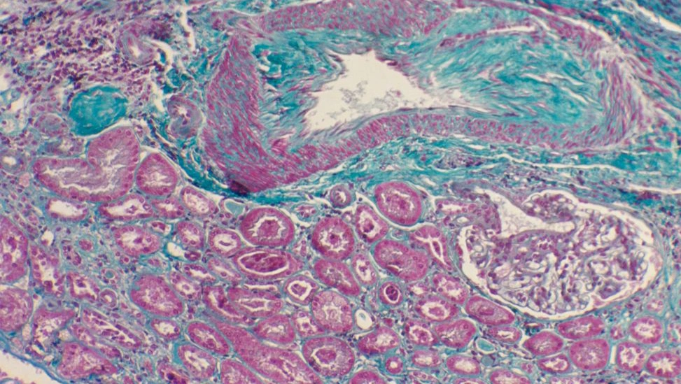 Experts warn of overlooked risks accelerating chronic kidney disease