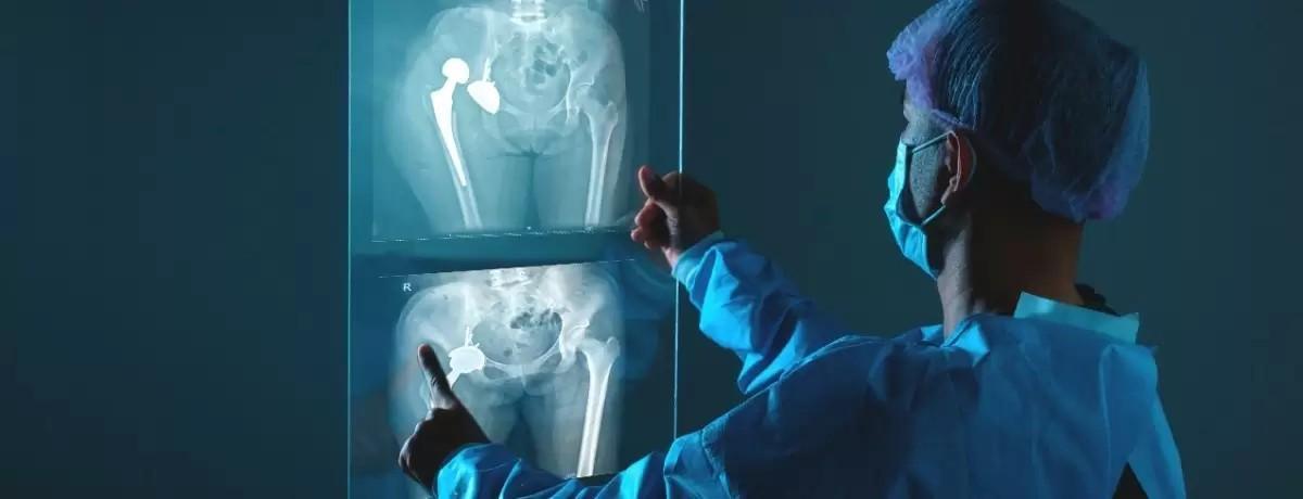 Protesi dell’anca. La nuova frontiera è il rivestimento tutto in ceramica
