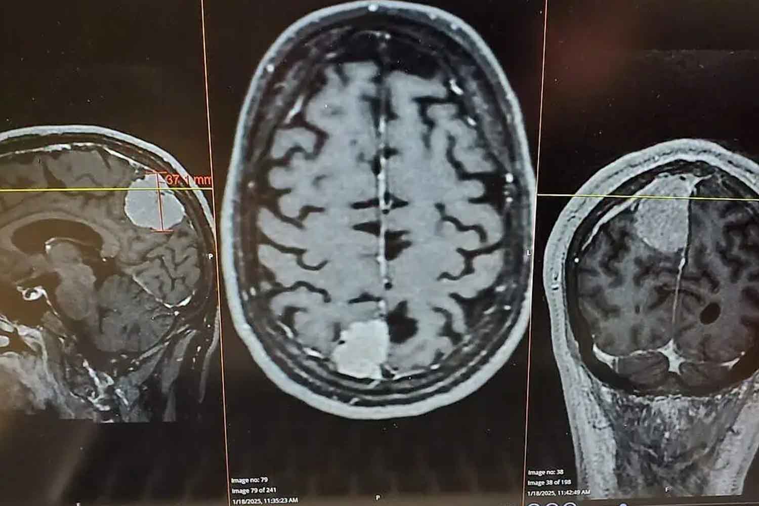 Cancro al cervello: scoperta una nuova strategia per bloccare le ...