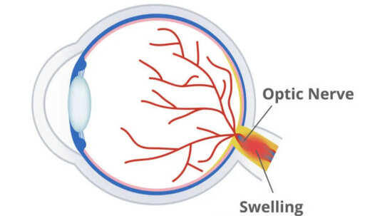 Blurred vision can be the first sign of multiple sclerosis - here's ...