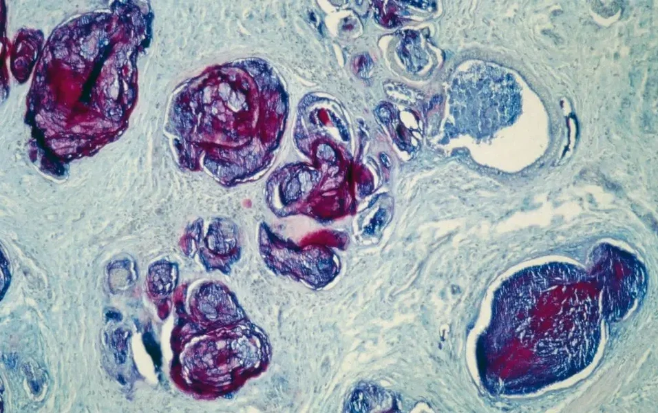 Doctors stress early detection as stomach cancer signs often subtle