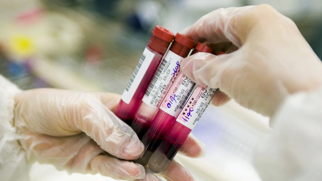 Galleri blood test cuts late-stage cancer diagnoses by over 20%