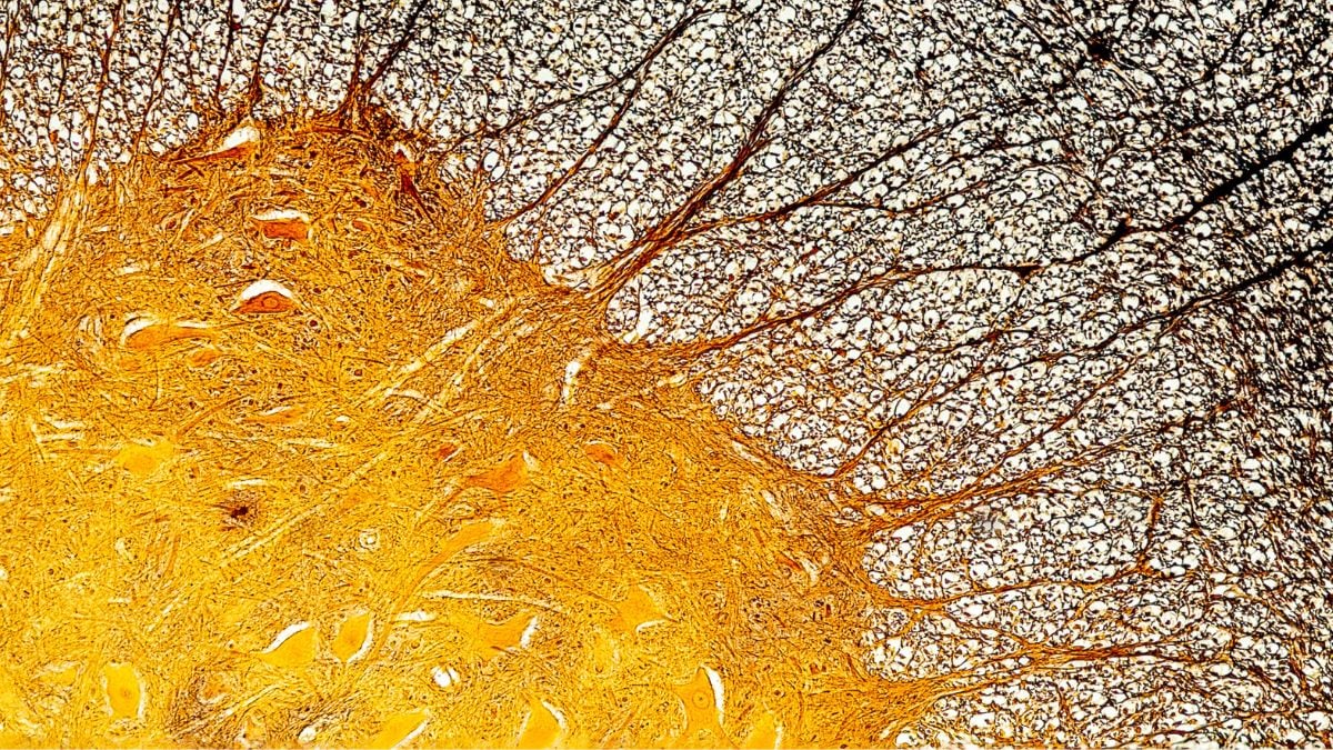 World MS Day: Immune cell discovery might explain multiple sclerosis at ...