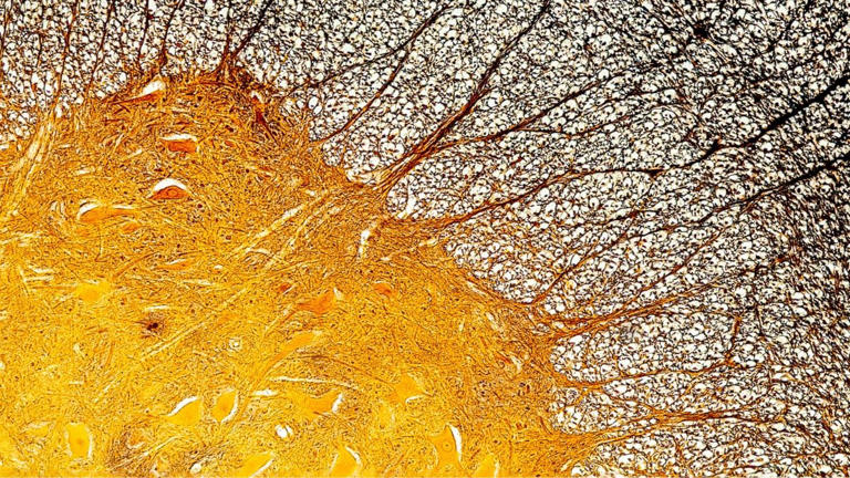 World MS Day: Immune cell discovery might explain multiple sclerosis at ...