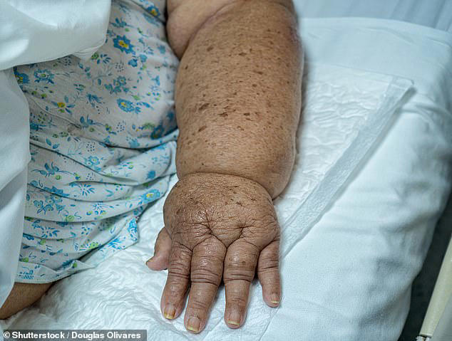 Breast cancer patients can safely skip invasive surgery that can cause ...