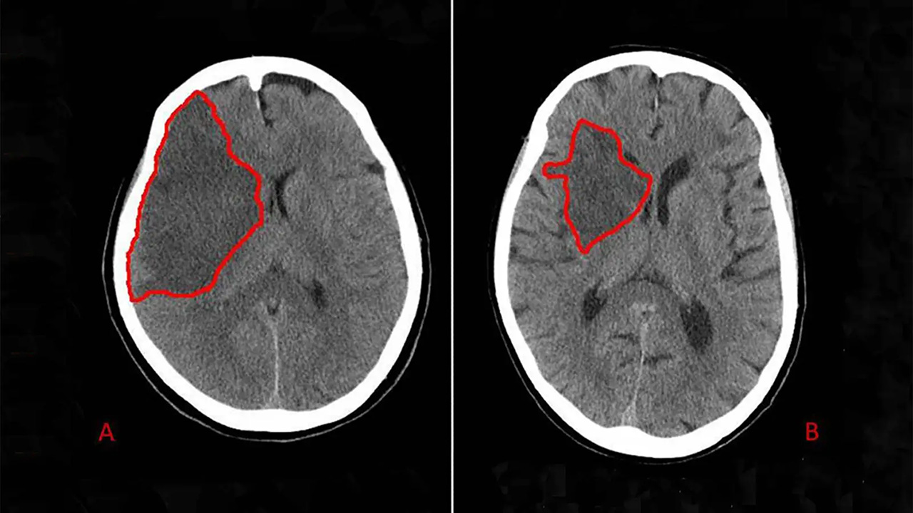 Warning signs of stroke you might be missing – know every one