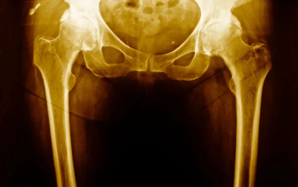 Top surgeon warns against delaying hip pain treatment