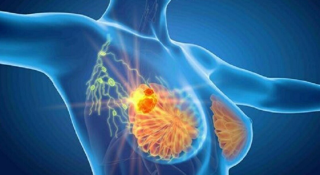 Tumore al seno, la svolta del test genetico. «Milioni di donne ...