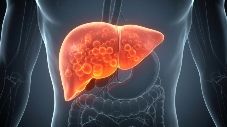 UC San Diego’s experimental pill just reversed the worst form of fatty ...