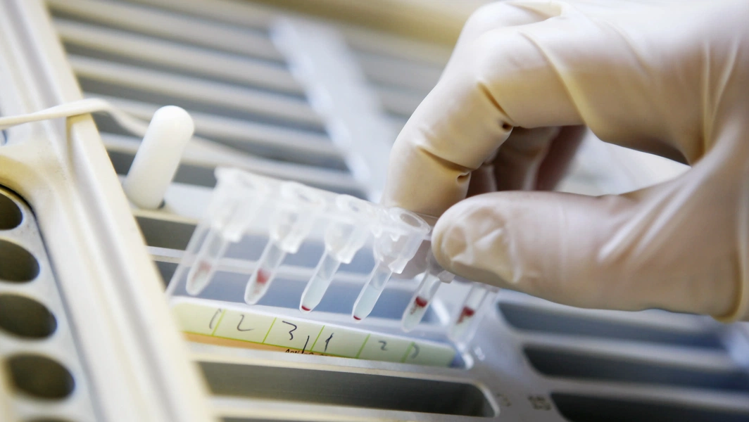 Galleri cancer blood test misses main goal in NHS trial