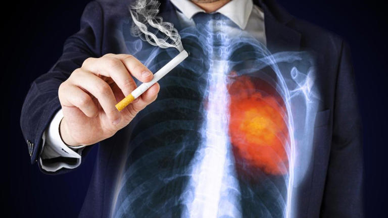 Los fumadores españoles de 54 años tienen una edad pulmonar de 70 ...