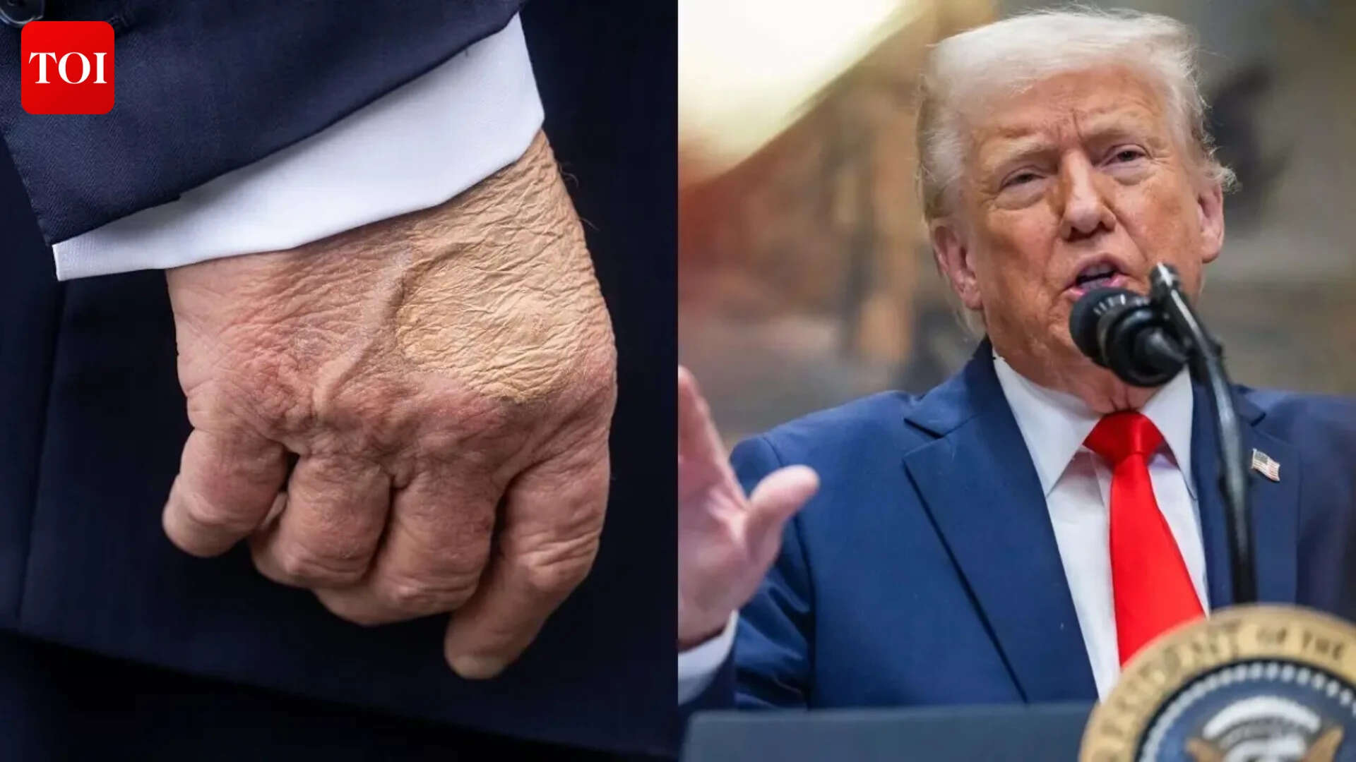 What happened to his hands? Donald Trump’s annual physical results ...