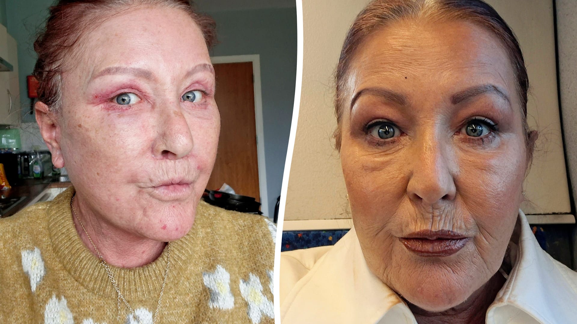 Woman saves $43,000 with facelift trip to Turkey despite online trolls