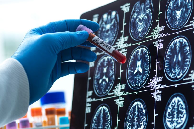 Blood test could detect Alzheimer's and Parkinson's 17 years early