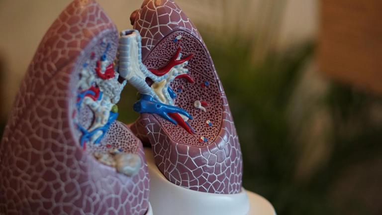 Cryoprobe boosts lung biopsy accuracy by nearly 10 points over forceps