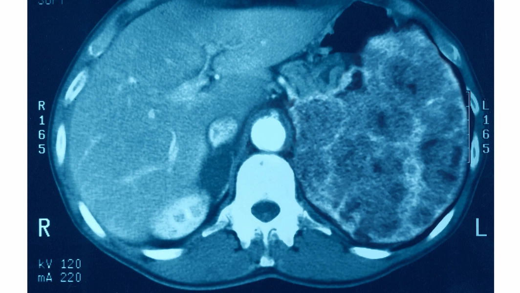 ASCO 2026 highlights phase III progress in NSCLC and lymphoma