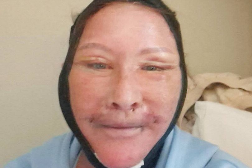 I spent £6k on Turkey facelift but trolls say it looks like it was done ...