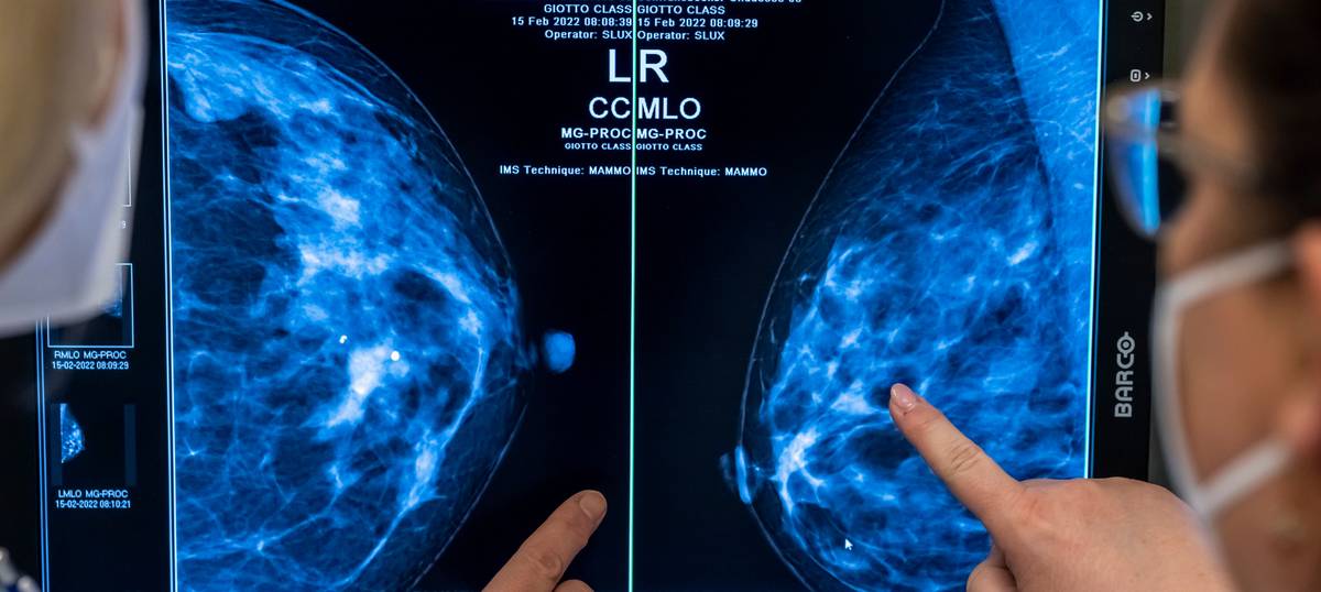 Novo estudo abre caminho para diminuição de casos do cancro da mama
