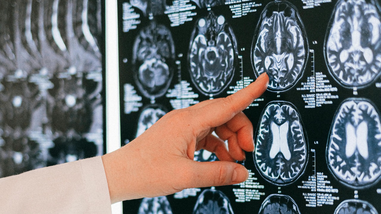 Long COVID brain scans just overturned the leading theory — there’s no ...