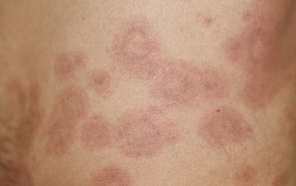 Researchers warn subtle lupus signs may precede kidney damage