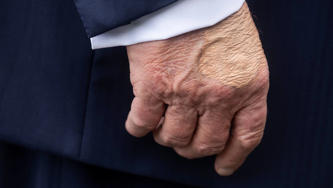 White House links Trump's hand bruises to handshakes, says he is fit