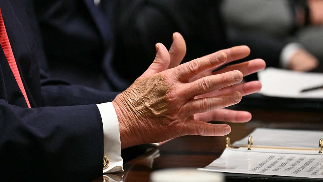 White House links Trump's hand bruises to handshakes, says he is fit
