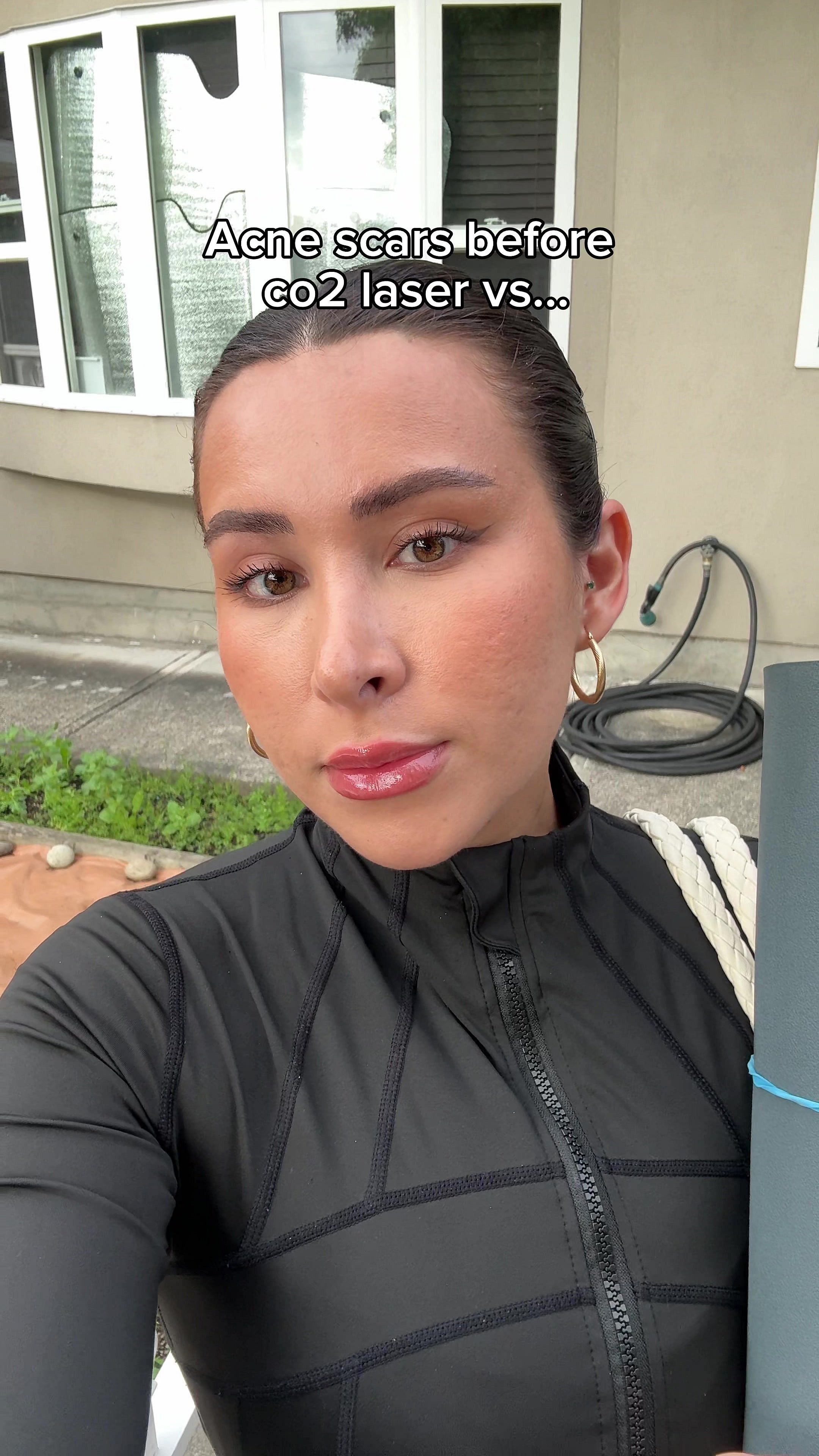 Before and after acne scars CO2 laser transformation journey