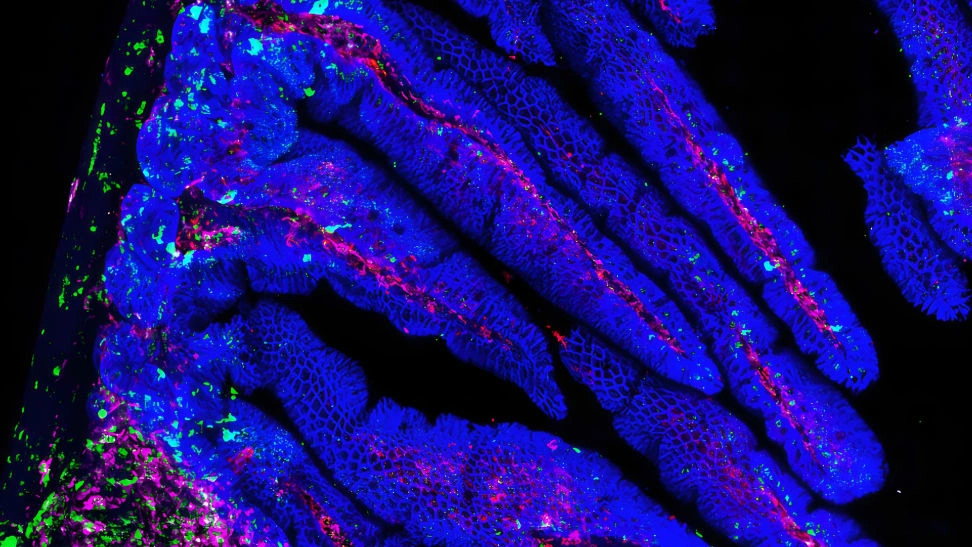 Fructose malabsorption linked to anxiety via gut–brain pathway