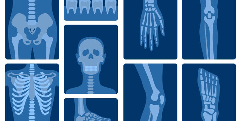 What all runners need to know about bone health