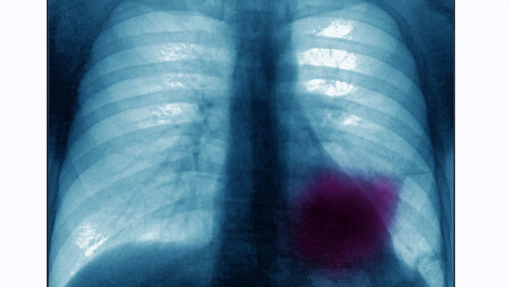 Blood protein test could personalize lung cancer treatment