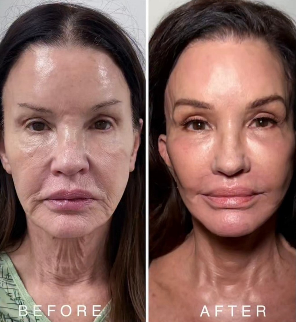 See supermodel Janice Dickinson before she underwent several cosmetic ...