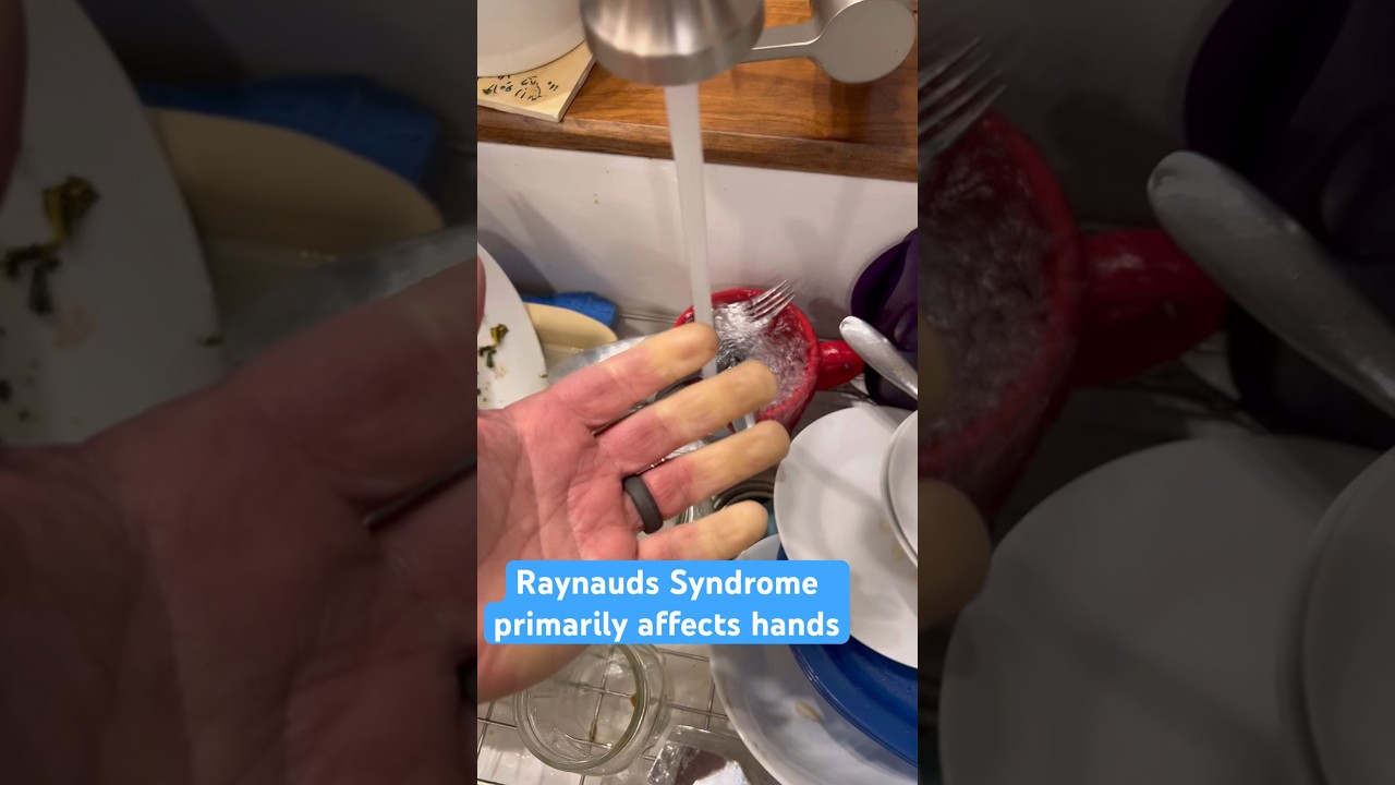 Raynauds Syndrome - cold decreases blood flow in extremities # ...