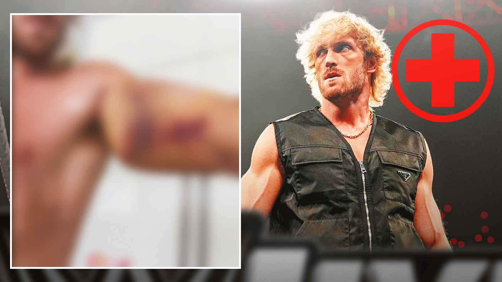 Graphic warning: WWE’s Logan Paul shares grotesque look at torn tricep ...