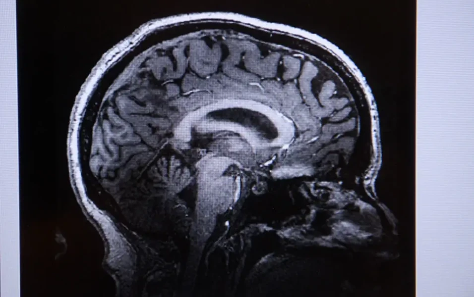 Blood test and brain scan show promise for early Alzheimer’s detection