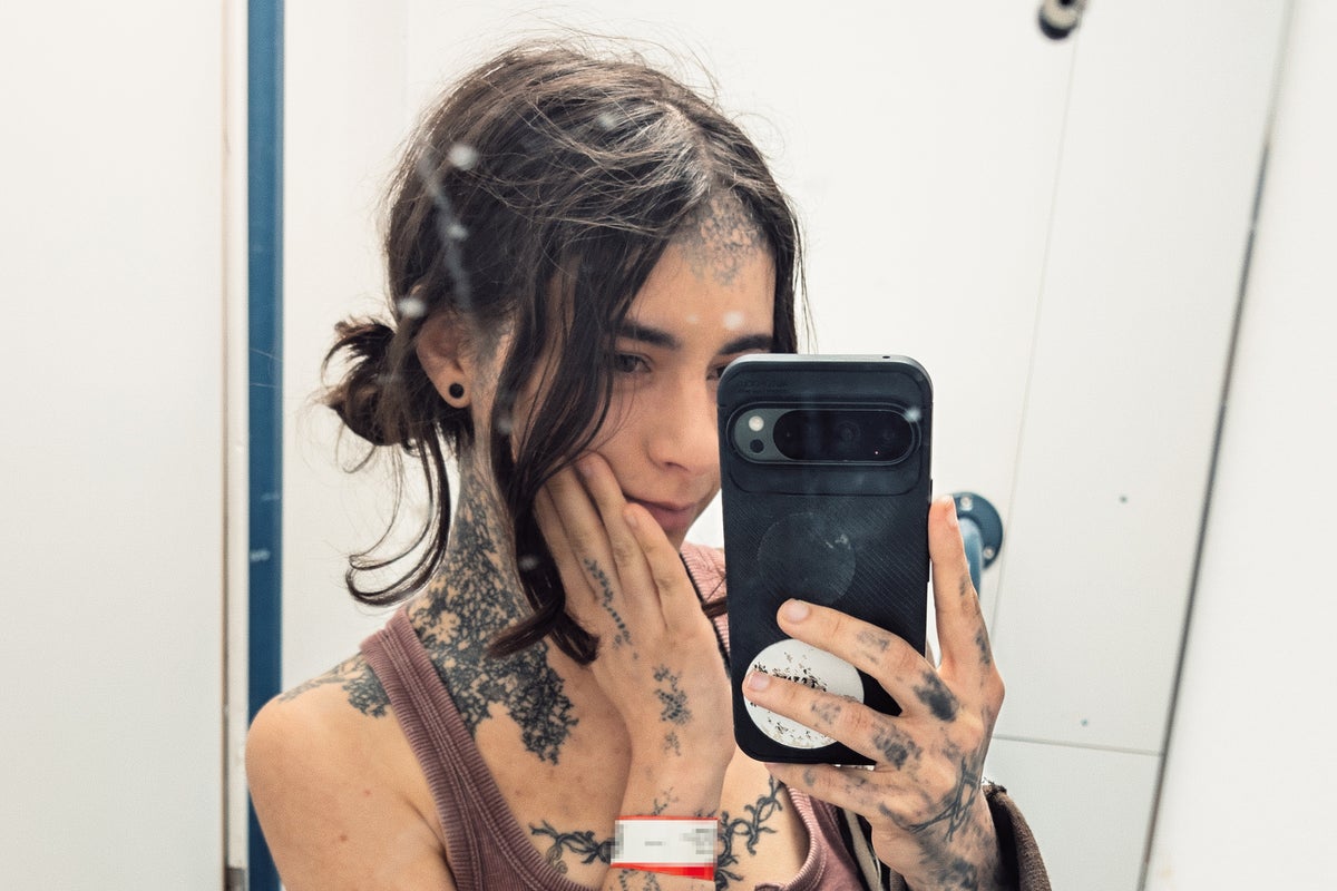 Student’s 'trick' of stretching skin turns out to be rare condition