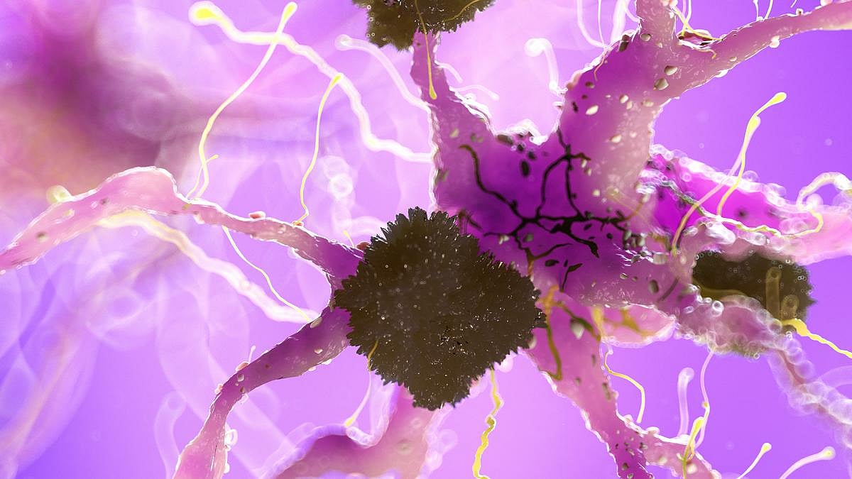 Alzheimer Disease Neuropathology Can Indicate Subtle Cognitive Decline