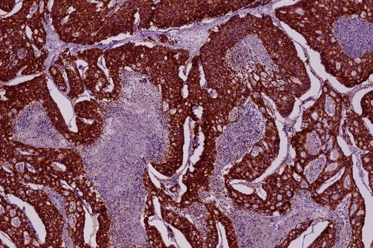 Daily tablet linked to 'unprecedented survival' in world's deadliest cancer