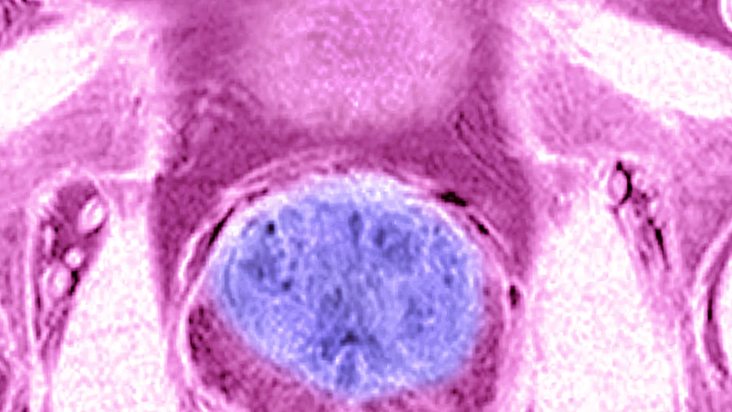Recognizing symptoms of prostate cancer